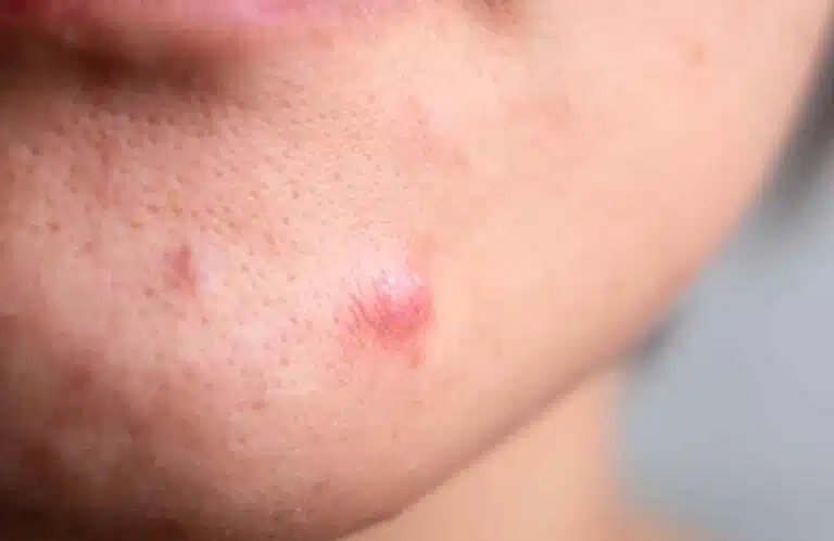 Petit bouton rouge sur le corps qui gratte : que faire ? - FCMRR